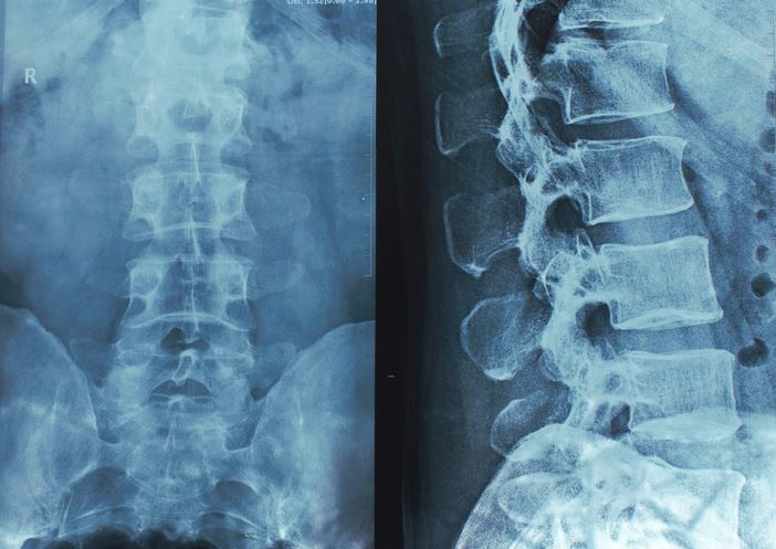 Understanding Spinal Injuries and Their Legal Impact